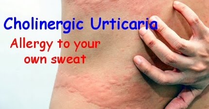 Skin Allergy caused by own Sweat - Cholinergic Urticaria