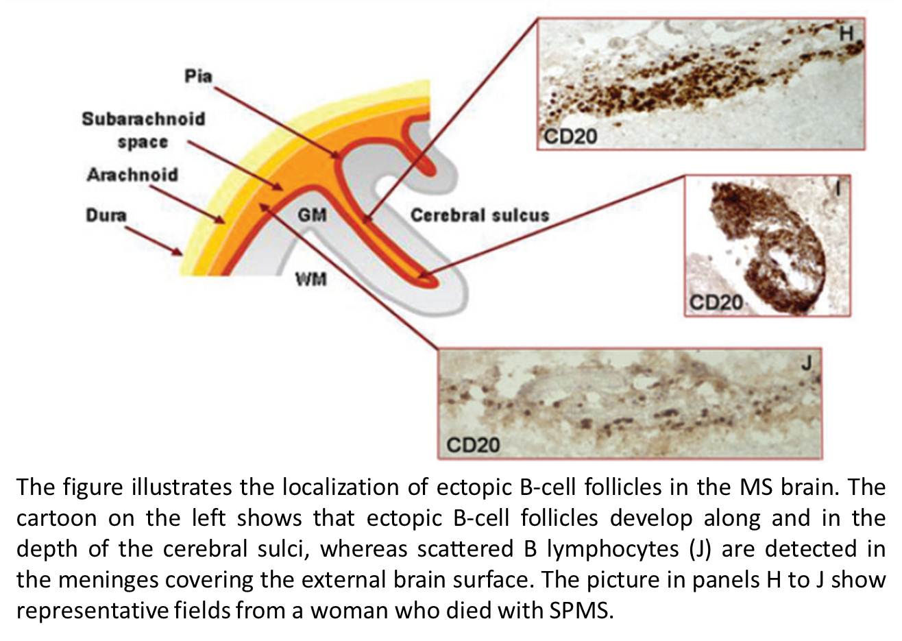 Multiple Sclerosis Research: Basic Science: Forming B cell follicles in ... Multiple Sclerosis Research: Basic Science: Forming B cell follicles in ...