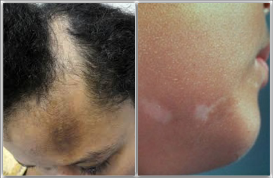 O que é Morféia ou esclerodermia? - Geri e Derme Beauty