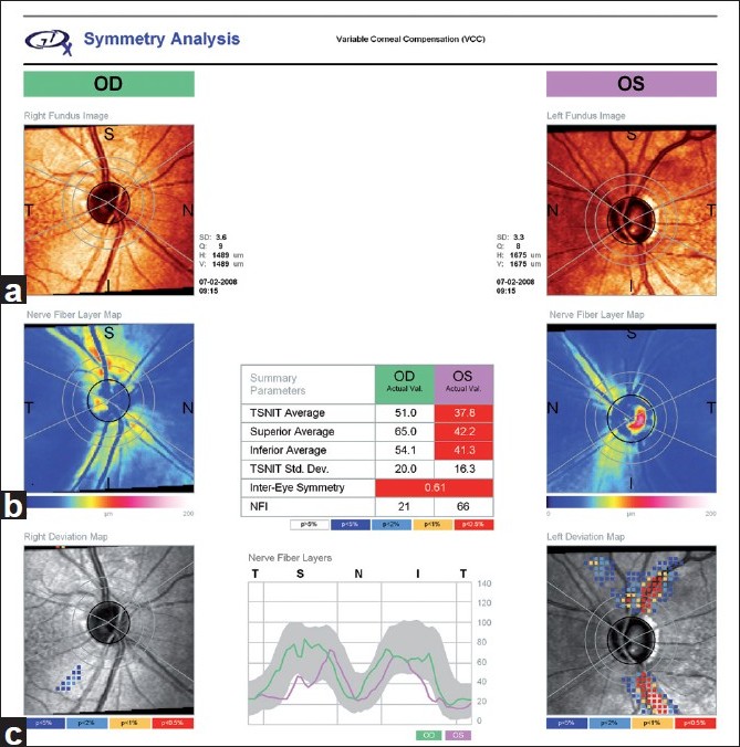CREDO-EXPERTO: GDX test v diagnostice a léčbě glaukomu