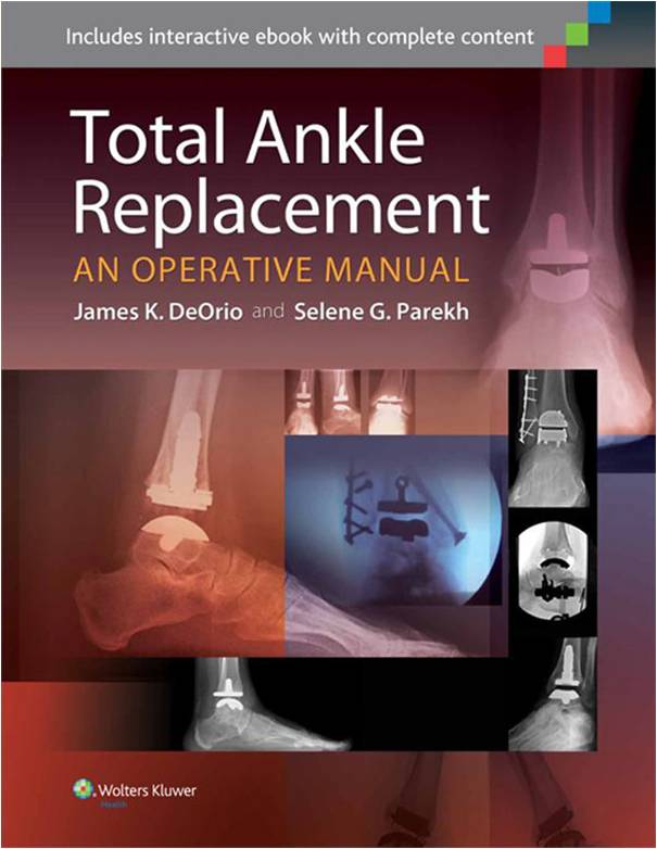 Total Ankle Replacement - Medical Yukti