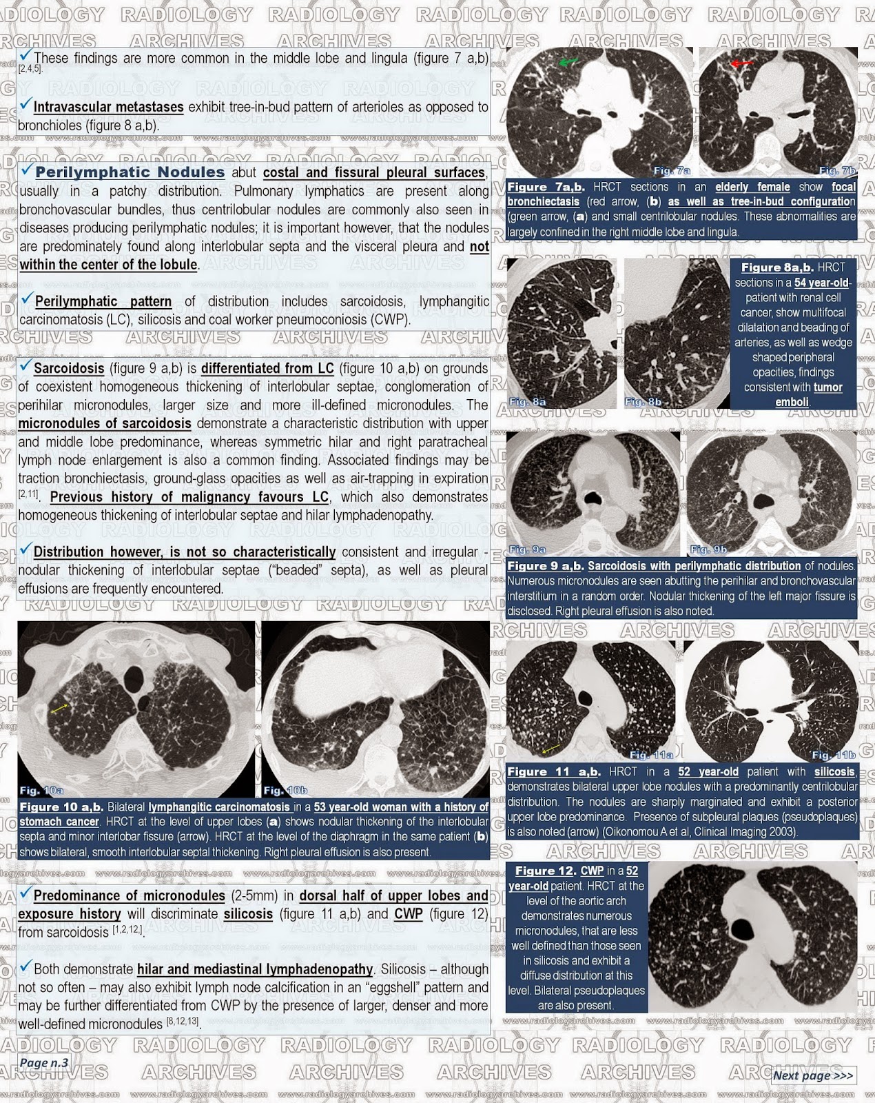 Radiology Archives: A guide to analyze Nodular Pattern in Interstitial ...