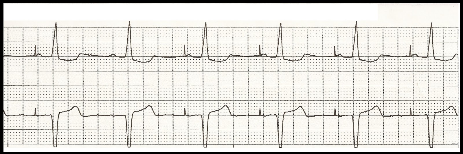EKG Rhythm Strip Quiz 100: Paced rhythms