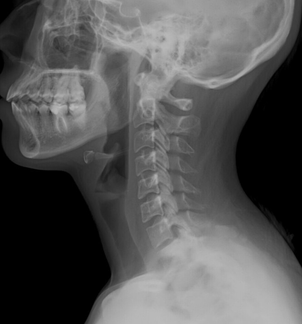 Teknik radiografi Cervical