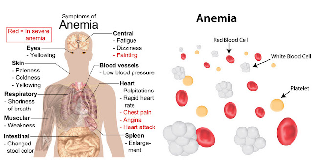 Hispanic Community Health Study / Study of Latinos: Anemia