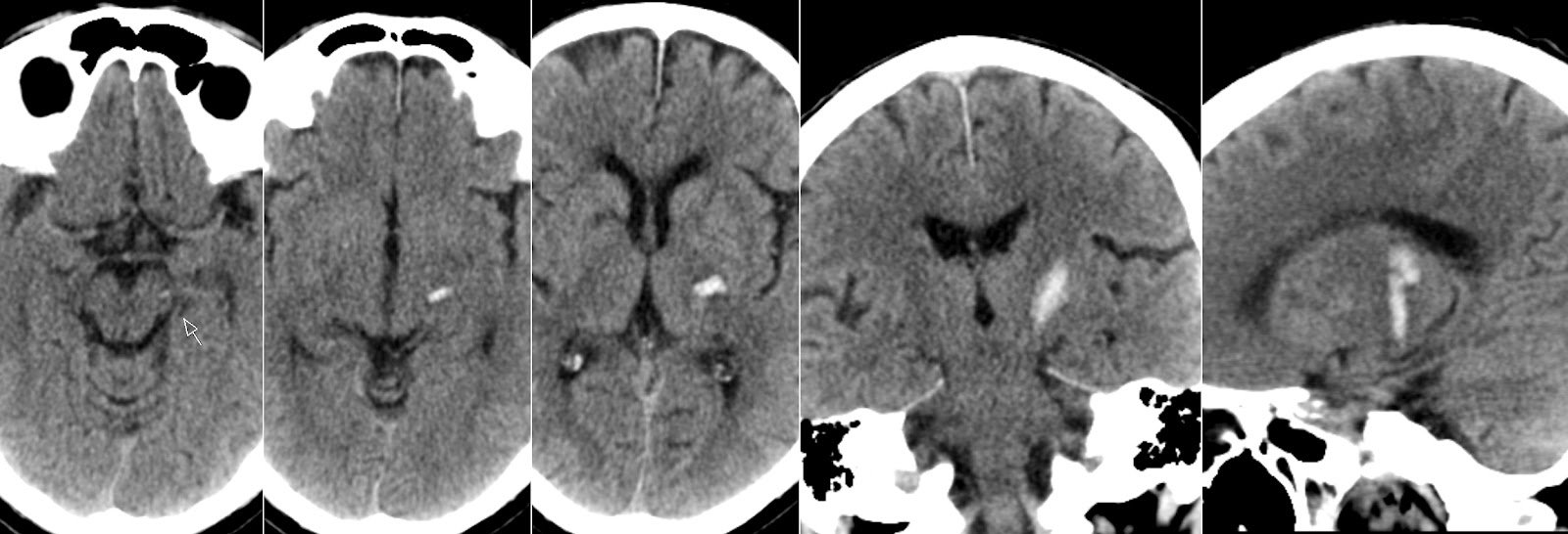 Ct Anatomy Of Internal Capsule at Terri Whobrey blog