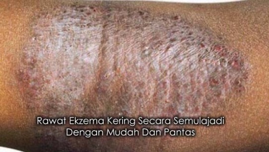 Psoriasis, Ruam Bayi Dan Semua Jenis Penyakit Kulit Sembuh Dengan Ruam ...