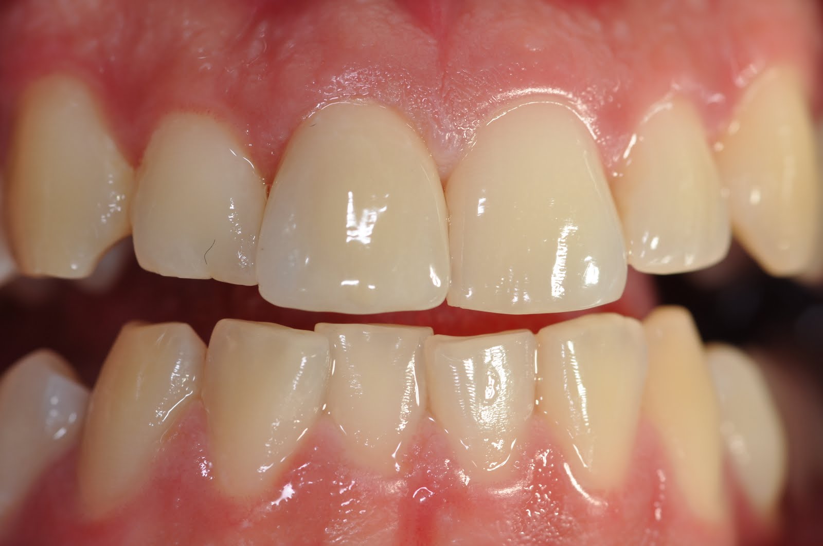 Number 1 Smile - The Cosmetic Dental Blog