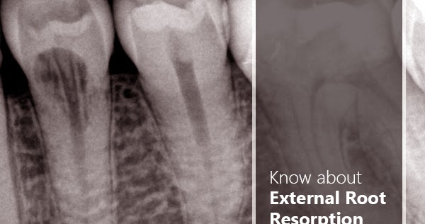 All That You Need to Know about External Root Resorption ~ Dental Blog ...