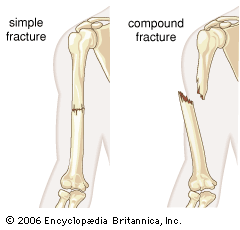 Blogão de Fisio: TIPOS DE FRATURAS