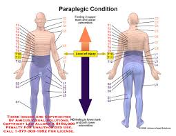PARAPLEGIA - EXPERT HOMEOPATHY