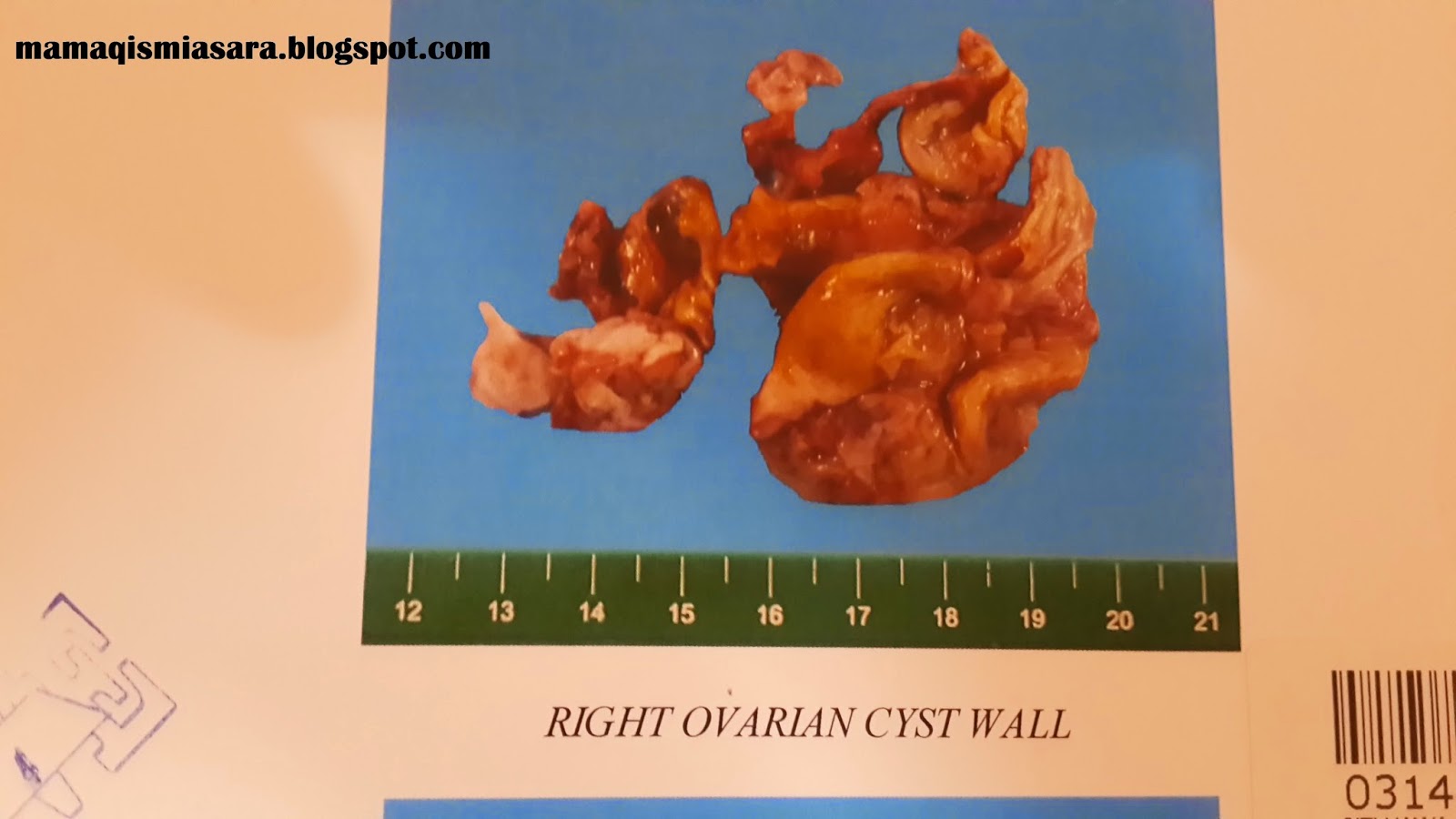 its All aBout mY sELf,mR.fAhZaL & lil qIstiNa: Gambar Cyst