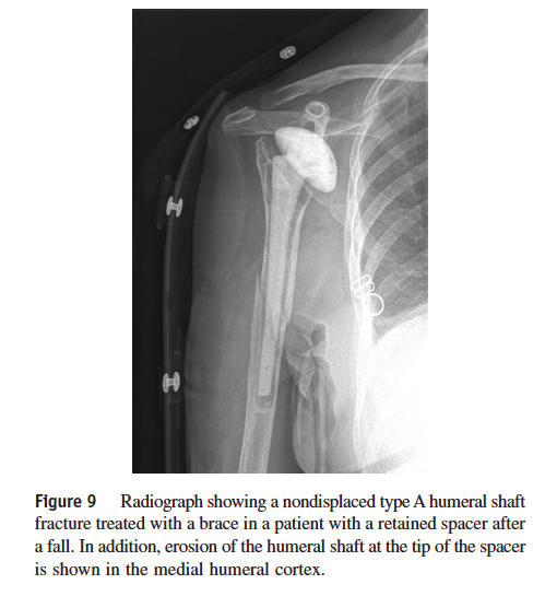 UW Shoulder and Elbow Academy: Are antibiotic spacers a benign ...