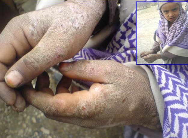 وائس آف بلوچ: Balochistan ‎''Skin disease caused by unhygienic situation''