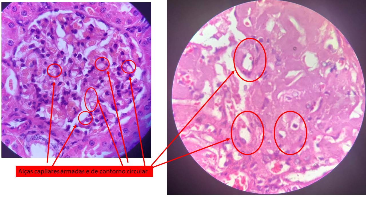 HISTOLOGIA90: RIM NORMAL E GLOMERULONEFRITES