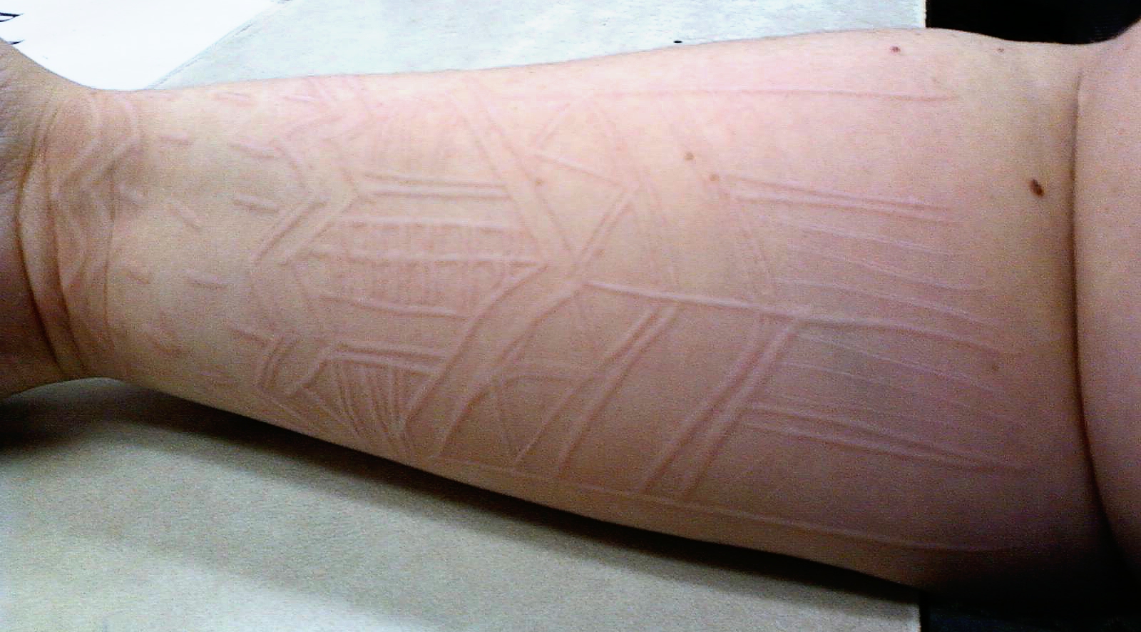 The Multi Mom: Dermographism (Chronic Urticaria)