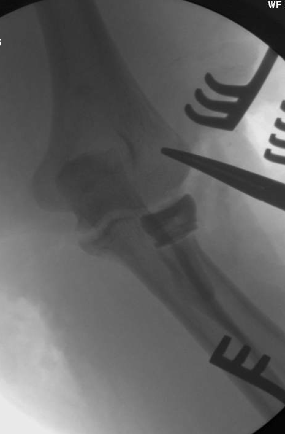 Shoulder and Elbow Surgery: Terrible triad injury. The importance of ...