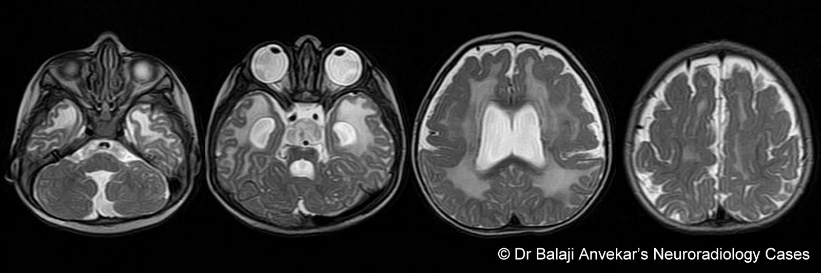 Dr Balaji Anvekar FRCR: Fukuyama Congenital Muscular Dystrophy MRI