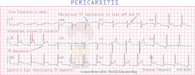 ECG Educator Blog : Pericarditis