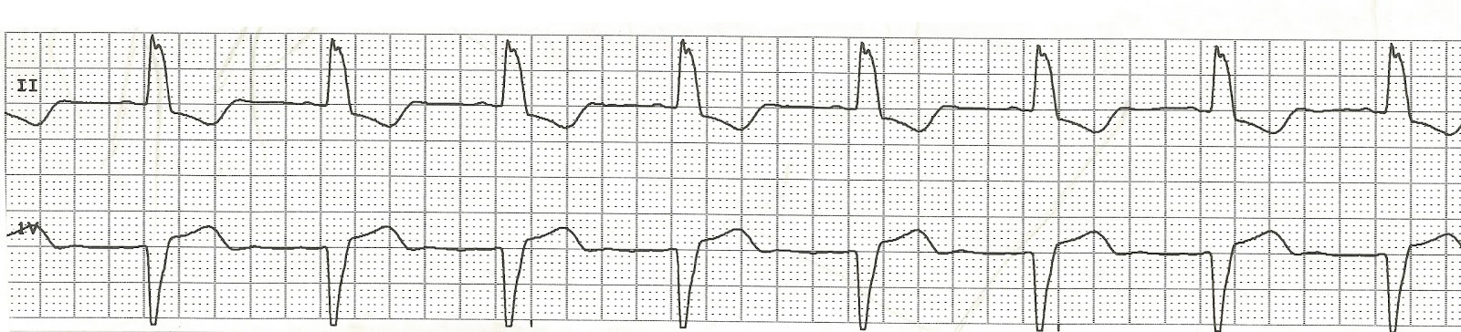 EKG Rhythm Strip Quiz 74