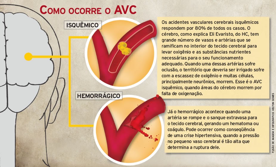 Trocando Idéias Acidente Vascular Cerebral