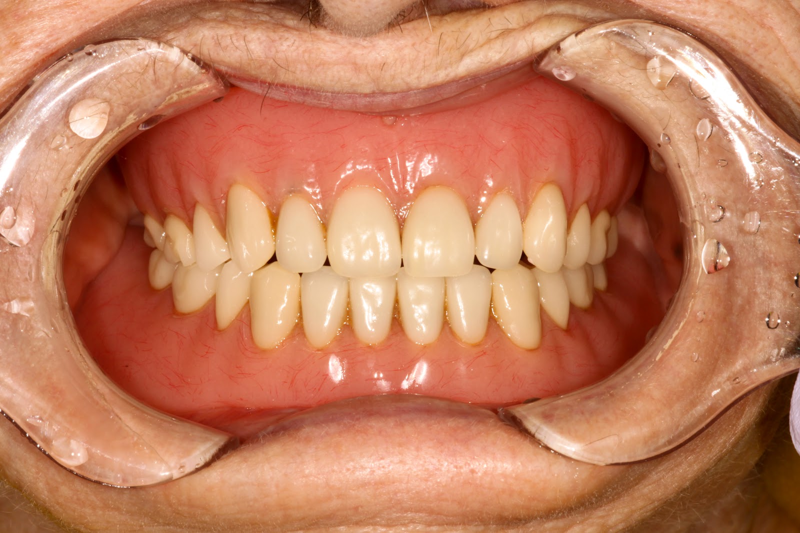 Boise Idaho Prosthodontics: Maxillary Complete Denture / Mandibular ...