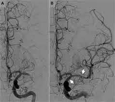 Medical Treatment Pictures-for Better Understanding: Thrombectomy ...