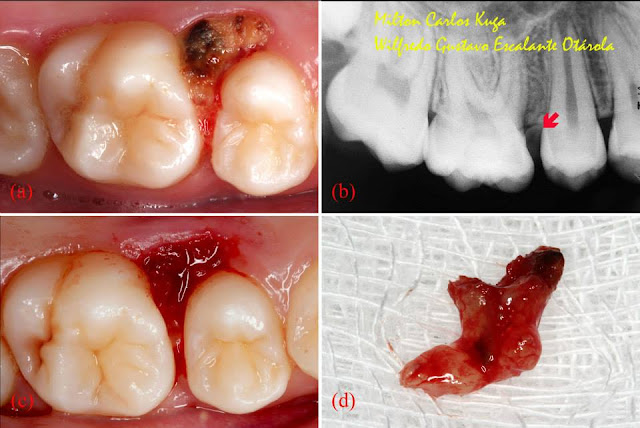 Caso clínico com indicação de "necrose tecidual"