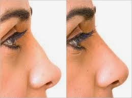 Nose Lifter Review: NOSE LIFTER
