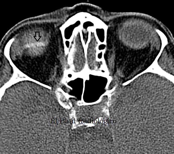El Baúl Radiológico: BANDA ESCLERAL DE SILICONA: HALLAZGOS EN ...