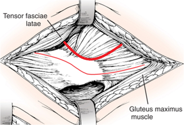 Joint Preservation and Replacement : modified hardinge approach