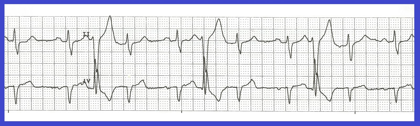 Basic EKG Rhythm Test 11