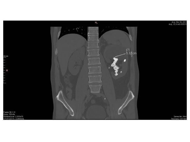 Staghorn Calculus - Department of Radiology @Universal