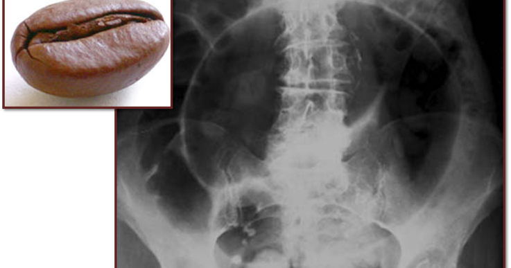 Tecnicos Radiologos: Signo radiológico: grano de café