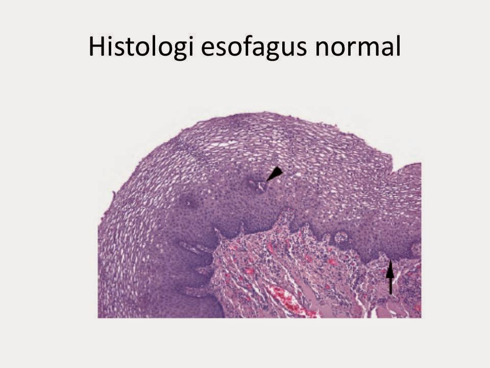 Reza Aditya Digambiro: Esofagitis