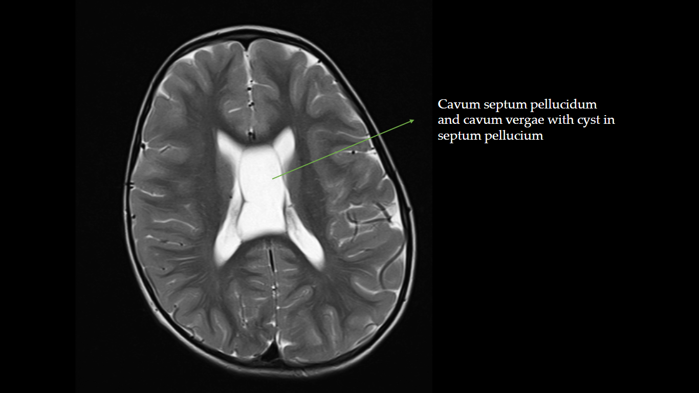 Ultimate Radiology : Arachnoid cyst of Septum Pellucidum