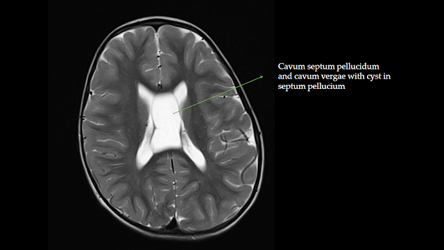 Ultimate Radiology : Arachnoid cyst of Septum Pellucidum