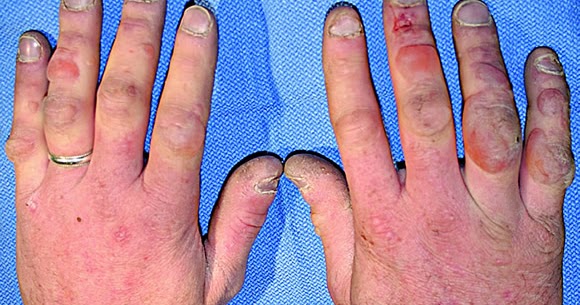 About Health: Frostbite and frostnip