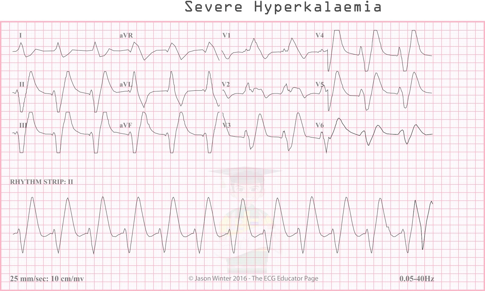 ECG Educator Blog : Hyperkaelemia ECG Features