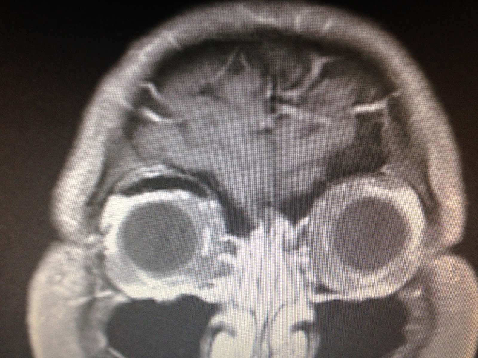 VIETNAMESE MEDIC ULTRASOUND: CASE 423: BLACK EYEBROW SIGN, Dr PHAN ...