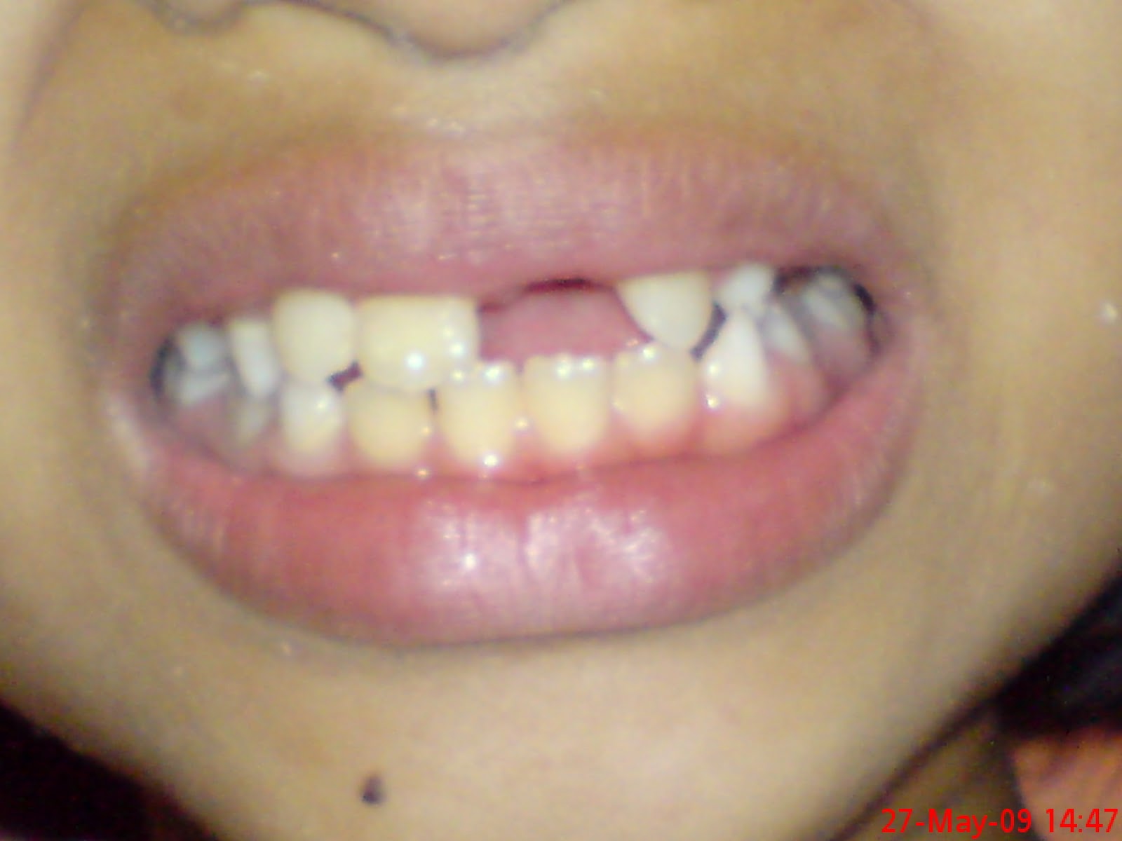 KLINIK GIGI SEHAT YOGYAKARTA: KEDOKTERAN GIGI ANAK