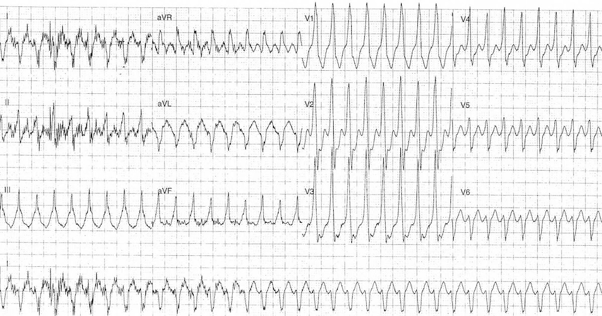 ECG of the Week: ECG of the Week - 4th April 2016 - Interpretation