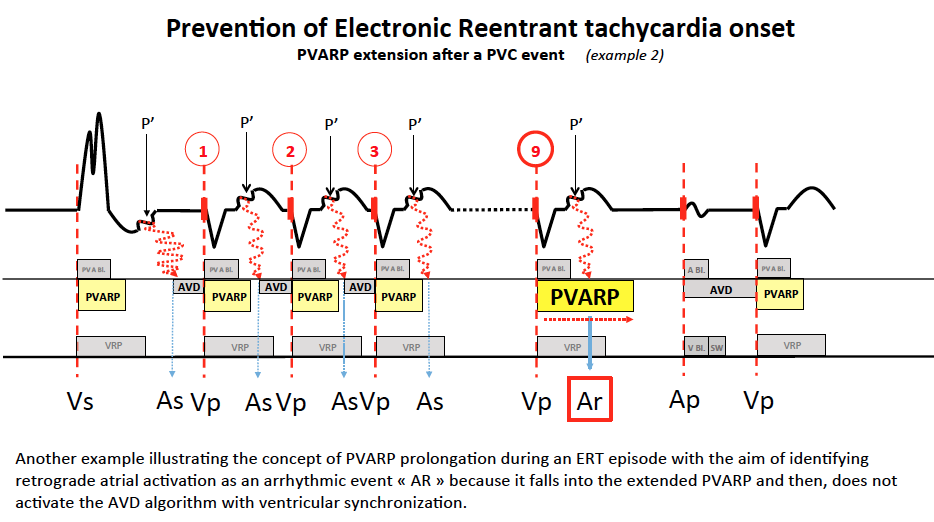 Dr Han Naung @ Henry Han : Electrophysiology and Heart Rhythm : AV ...