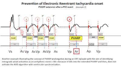Dr Han Naung @ Henry Han : Electrophysiology and Heart Rhythm : AV ...