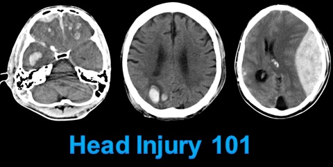 Head Injury