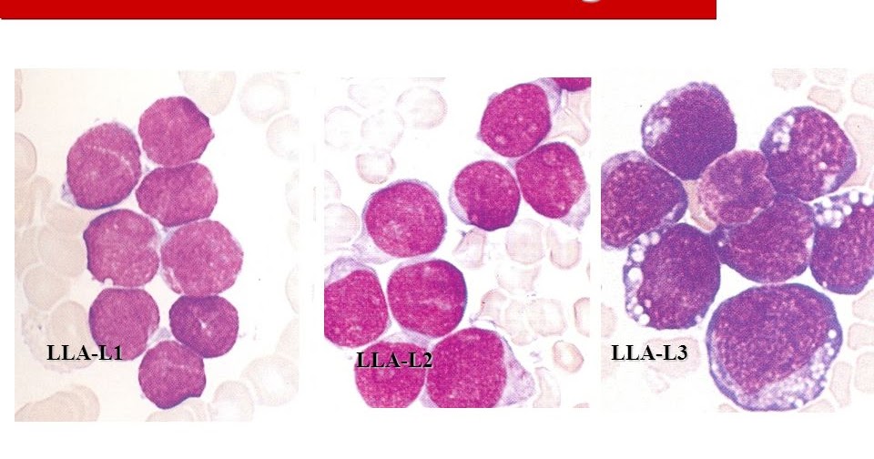 Hematología Fichas: LEUCEMIA LINFOIDE AGUDA
