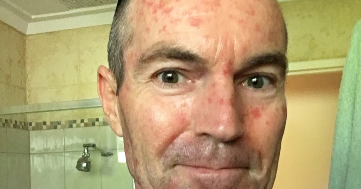 Efudix Treatment: Day 8 - Start of Week 2