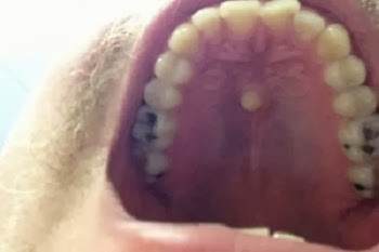 Talktokemi (TtK) : Weird!! Tooth Growing From Upper Jaw