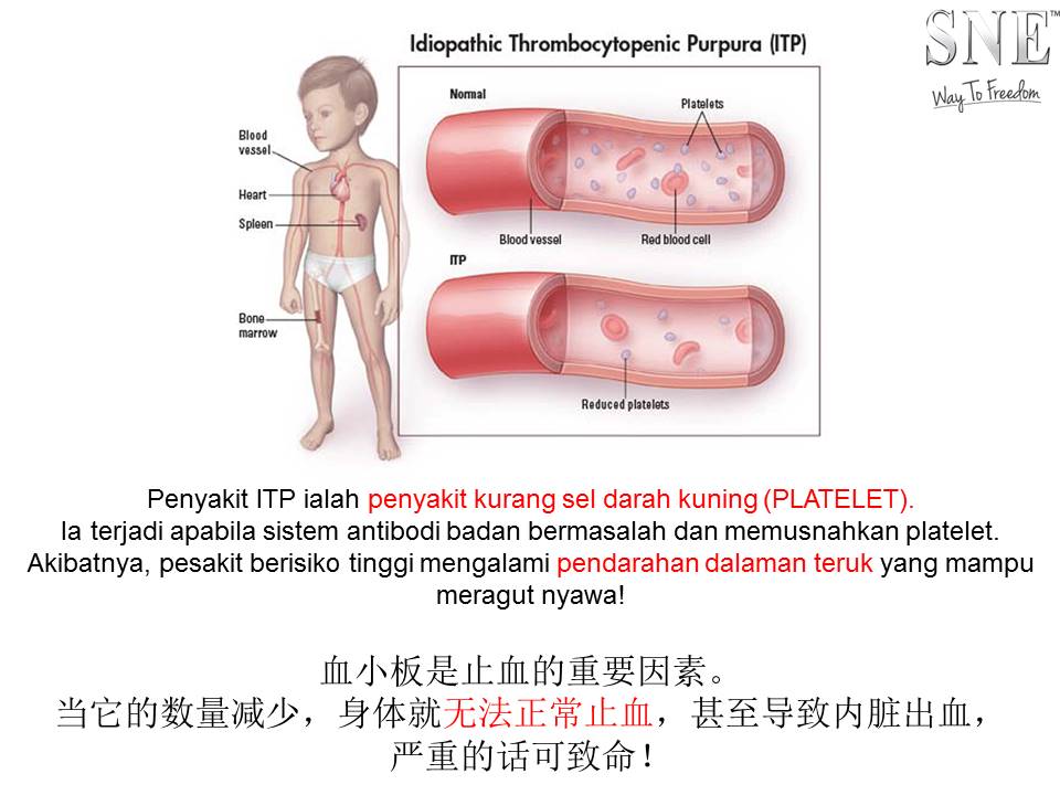 Idiopathic Thrombocytopenic Purpura (ITP)