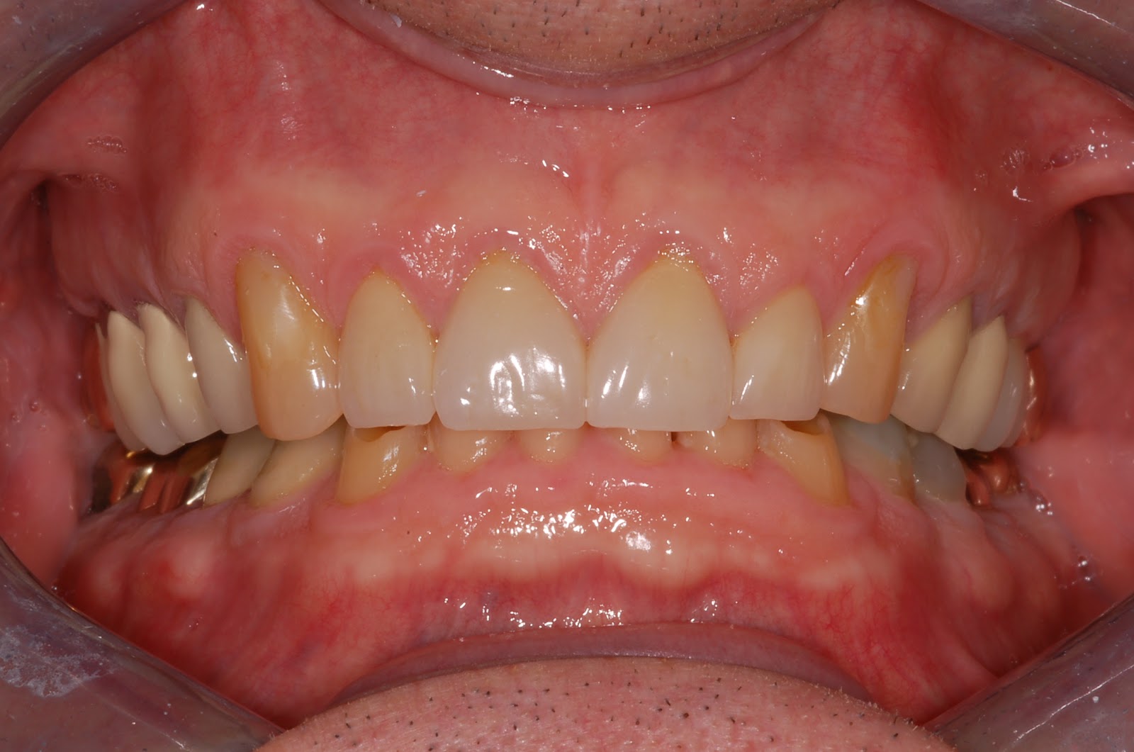 Ground down teeth? - Bauer Smiles